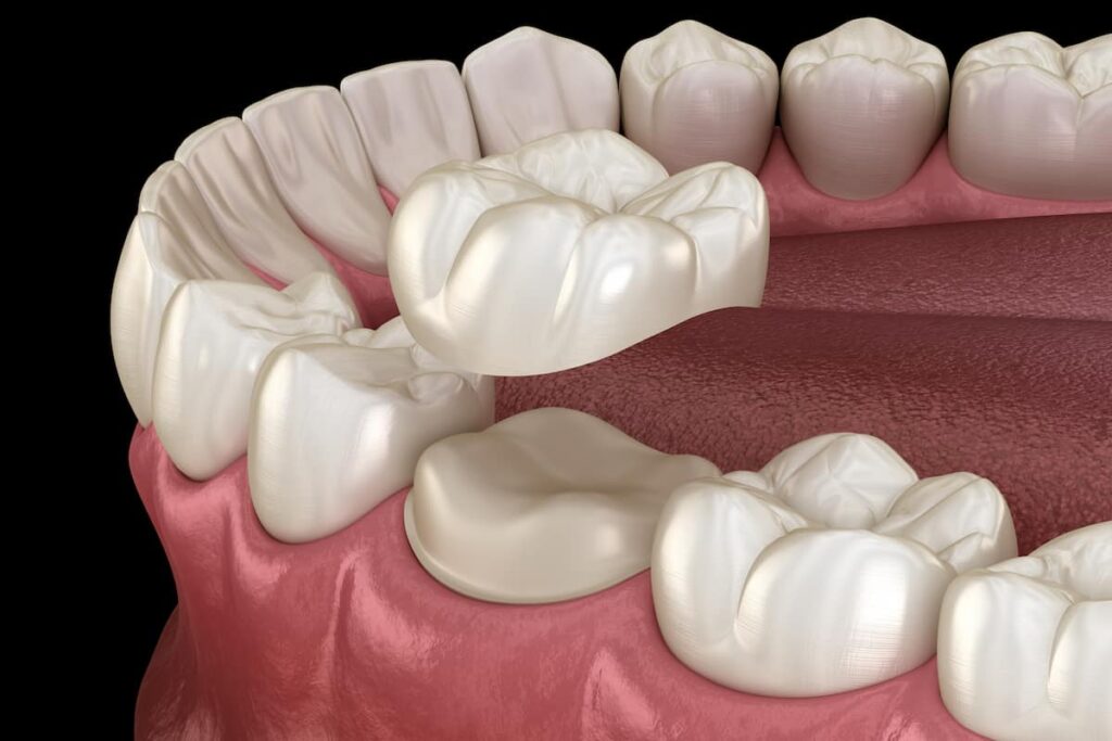 Why Dental Crowns Matter for Older Adults